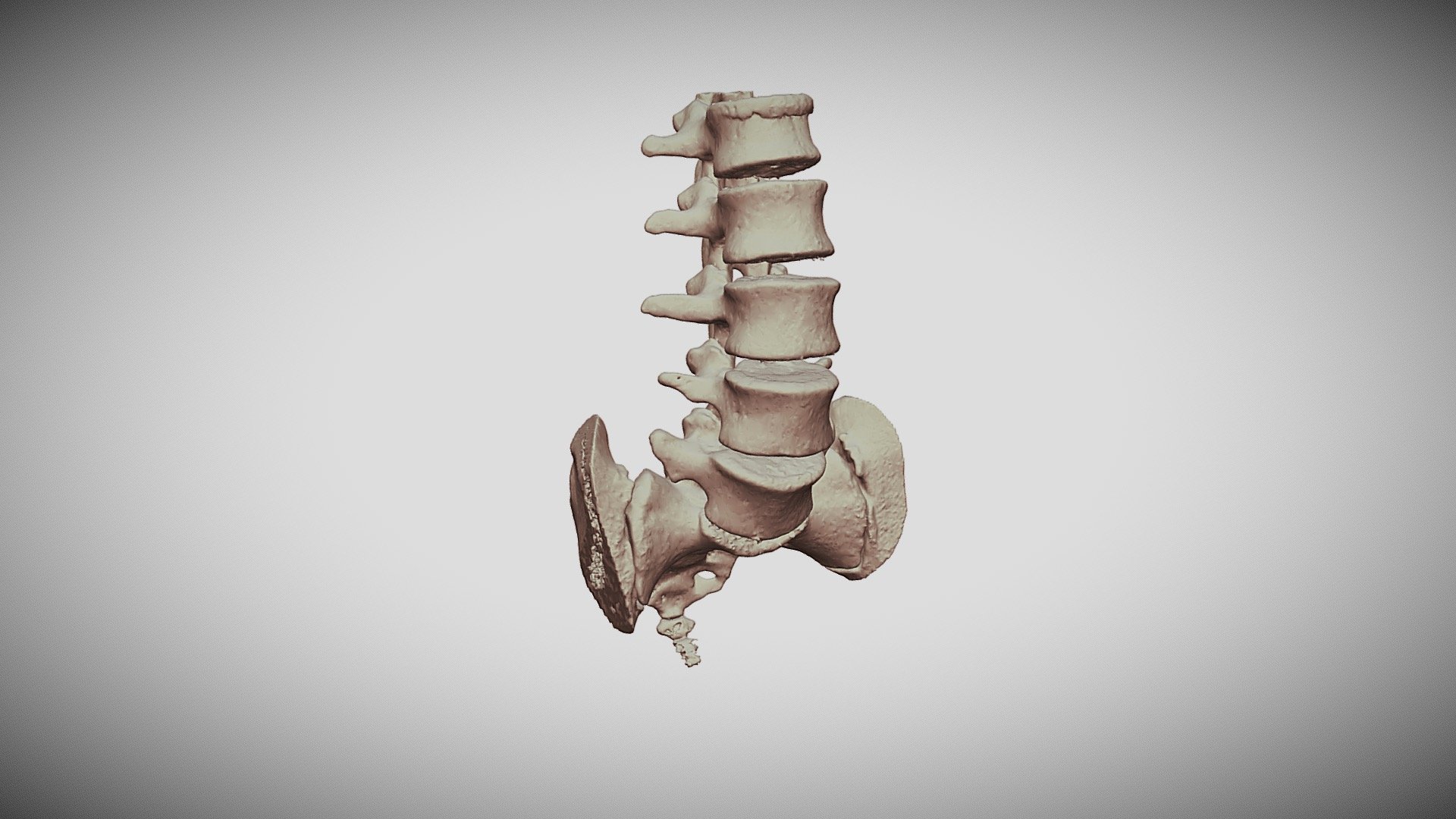 AOspine_Thoracolumbar_TypeA1_L1 - 3D model by E_Schulz [13662c3 ...