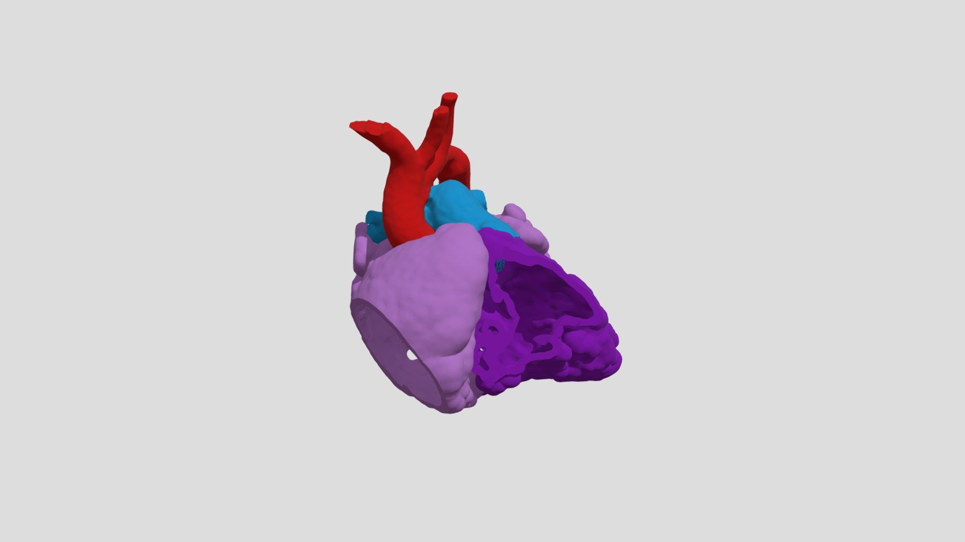 ASD, VSD, Hypoplastic Aortic Isthmus, PDA (S330) - 3D model by NCH ...
