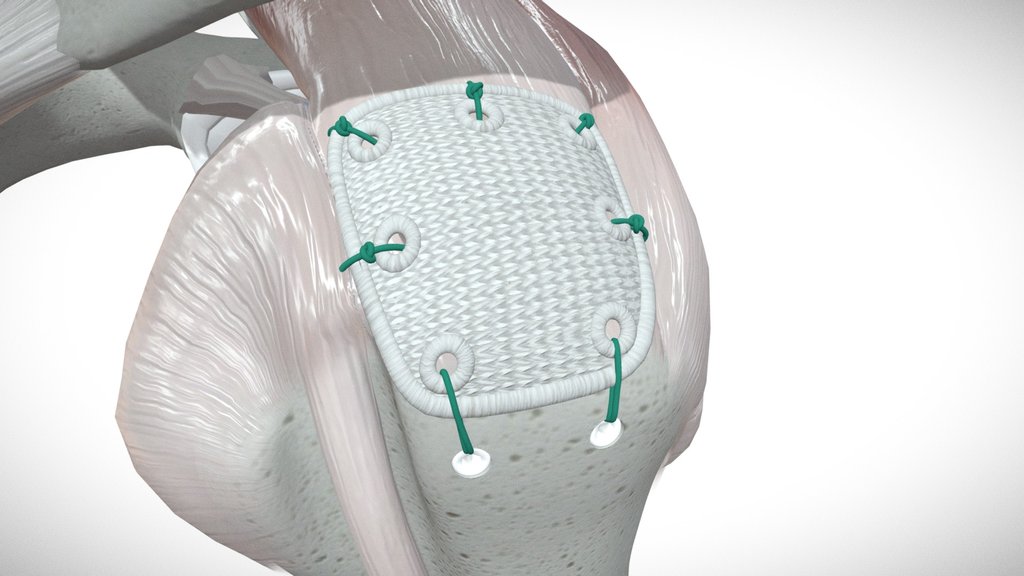 rotator cuff - A 3D model collection by bobbyofna - Sketchfab