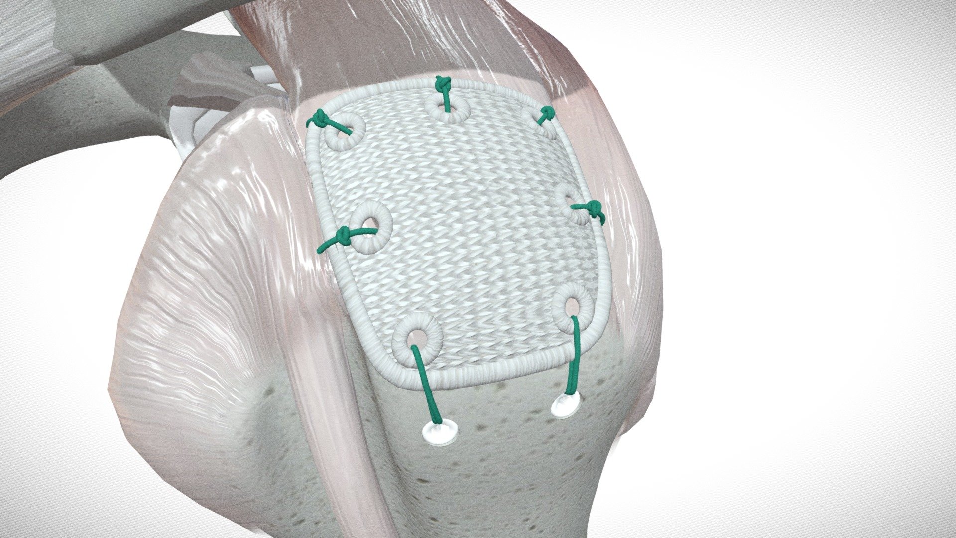 Pitch-Patch Open Technique - 3D model by Xiros (@_Xiros_) [13de749 ...
