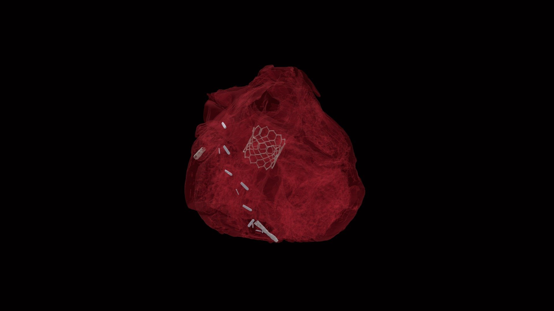 CC37025 Heart with Stents, Valve, Staples - Download Free 3D model by ...