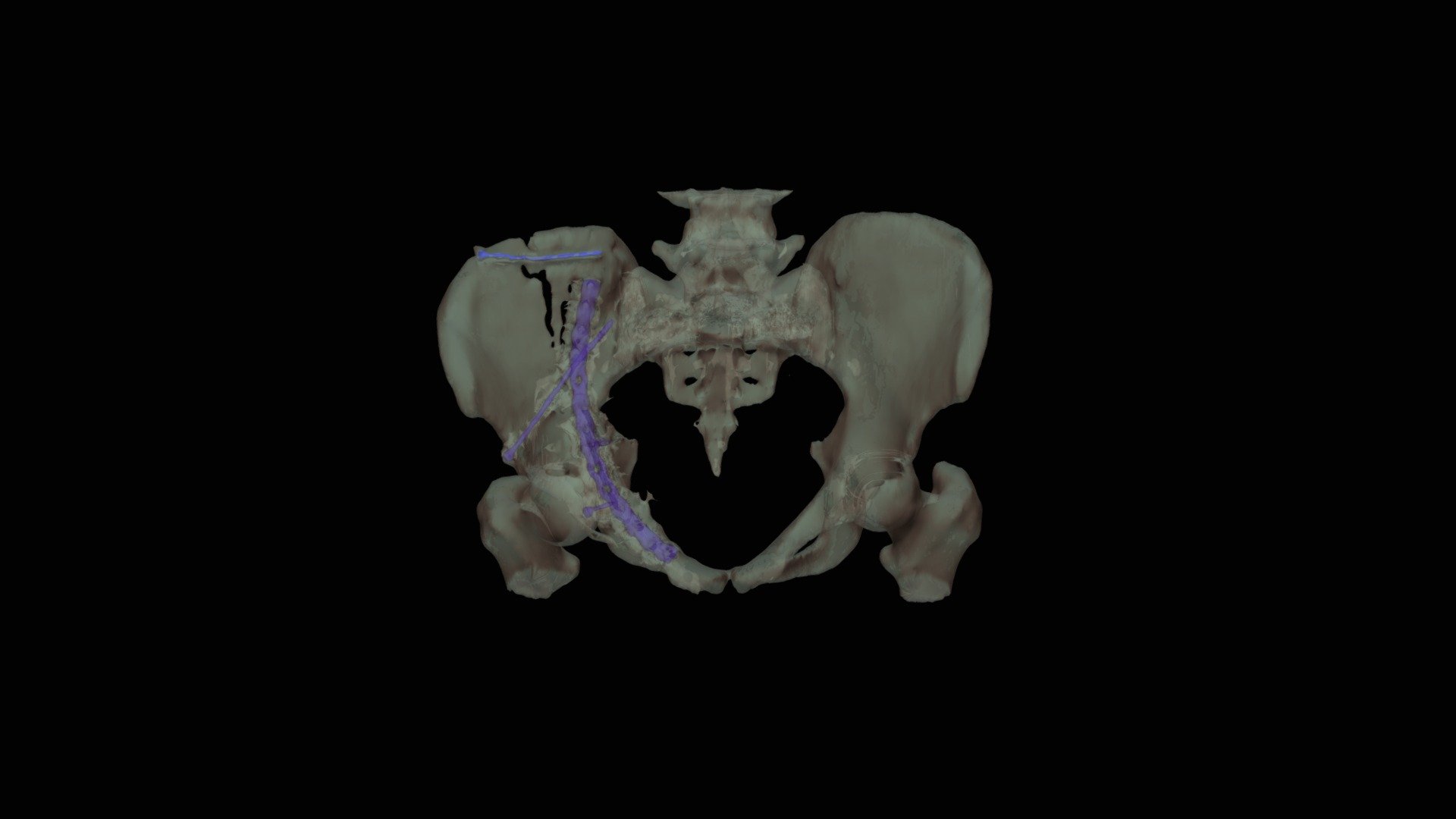 Pelvis Segmentation - 3D model by cmkellaway [1480d82] - Sketchfab