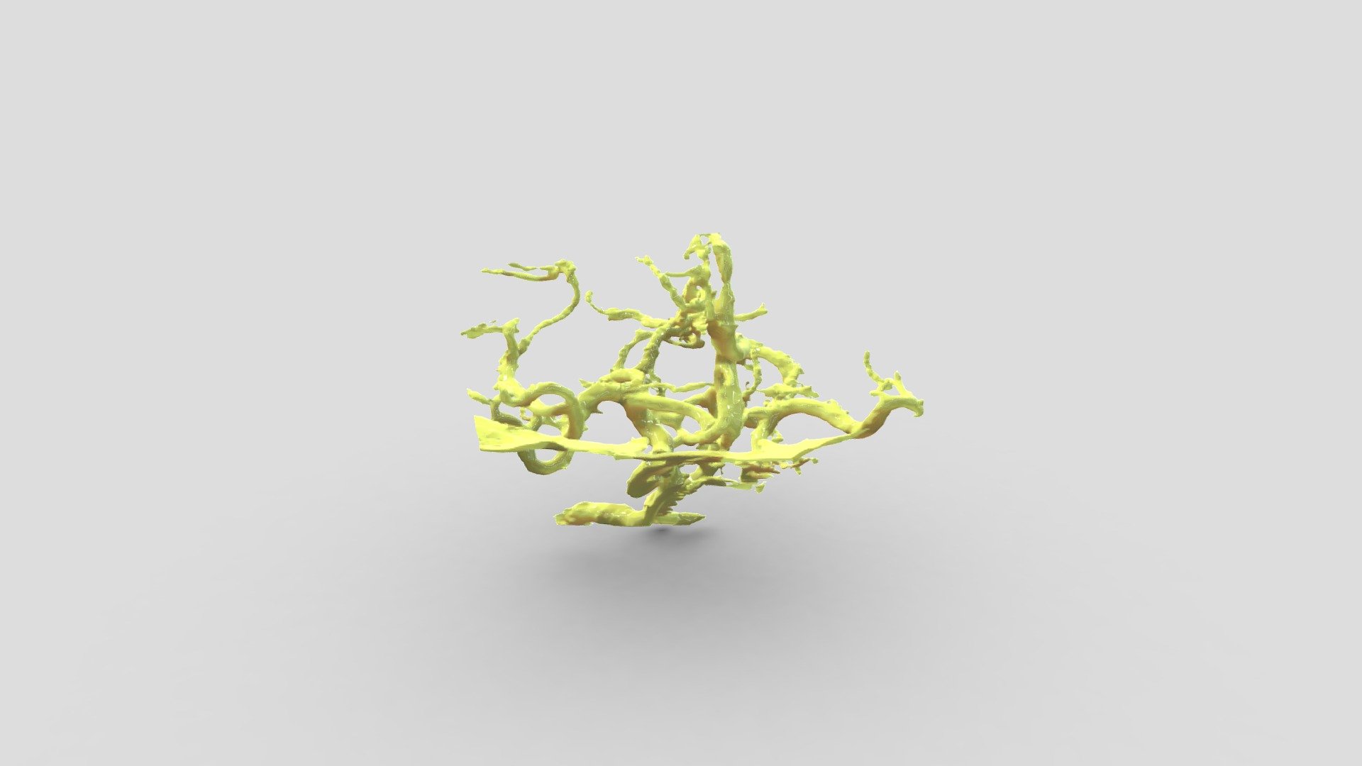 AGM - ACoA Aneurysm - 3D model by Dr. Samuel Damin (@sdamin) [14fd4e2 ...