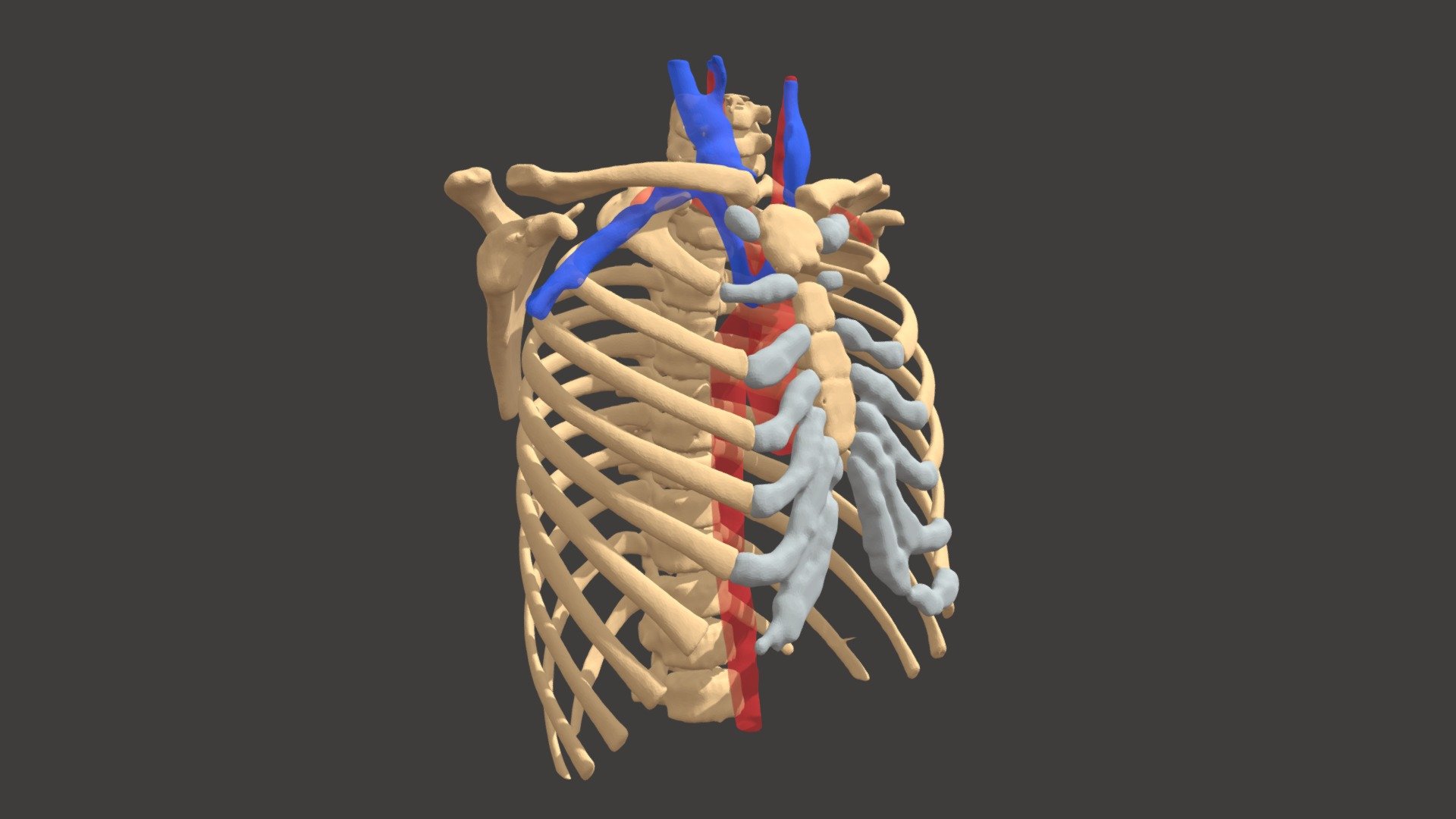 Pathology of the first right rib - 3D model by thorac.topsurgery ...