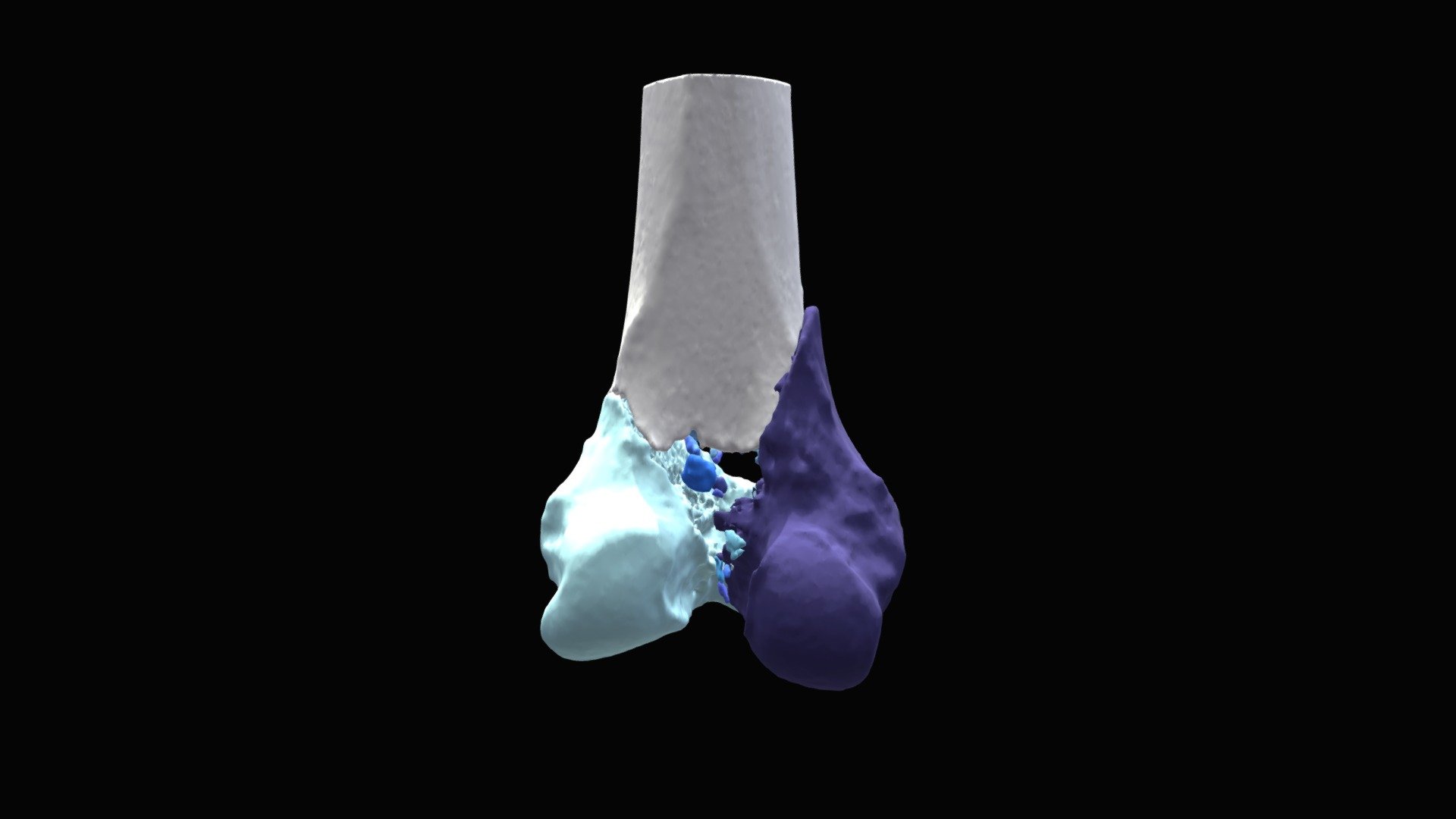 Session 4.06 | Distal Femur Fracture - Download Free 3D model by World ...
