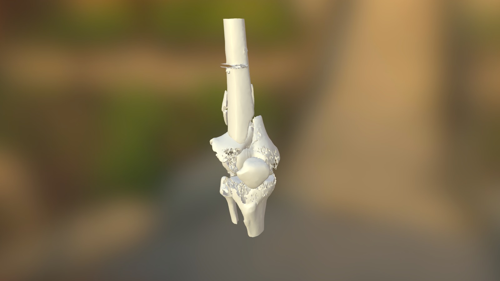 Knee - Distal Femur fracture sku 058 - 3D model by orto3d [168c847 ...