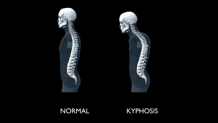 Kyphosis 3D models - Sketchfab