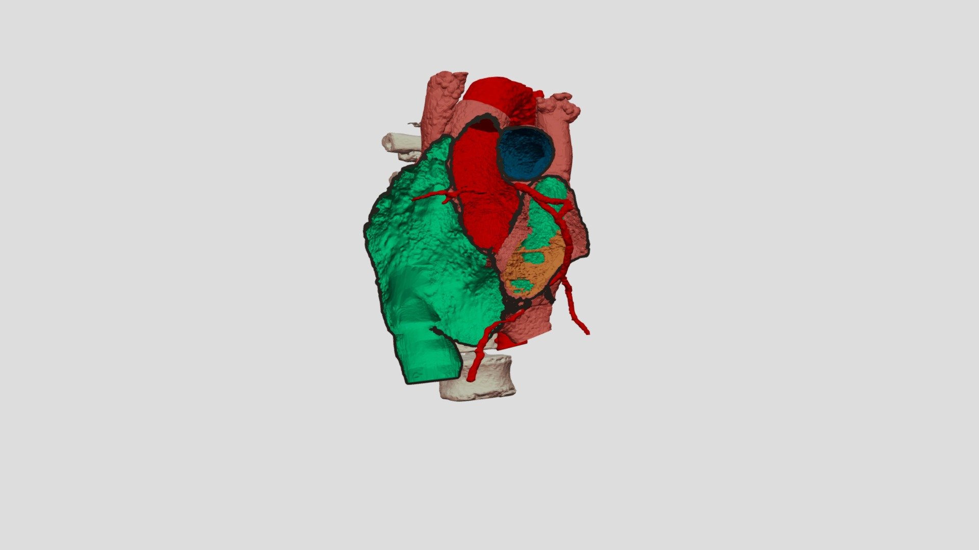 Dextrocardia & Coronary Sinus Septal Defect - 3D model by NCHS Cardiac ...