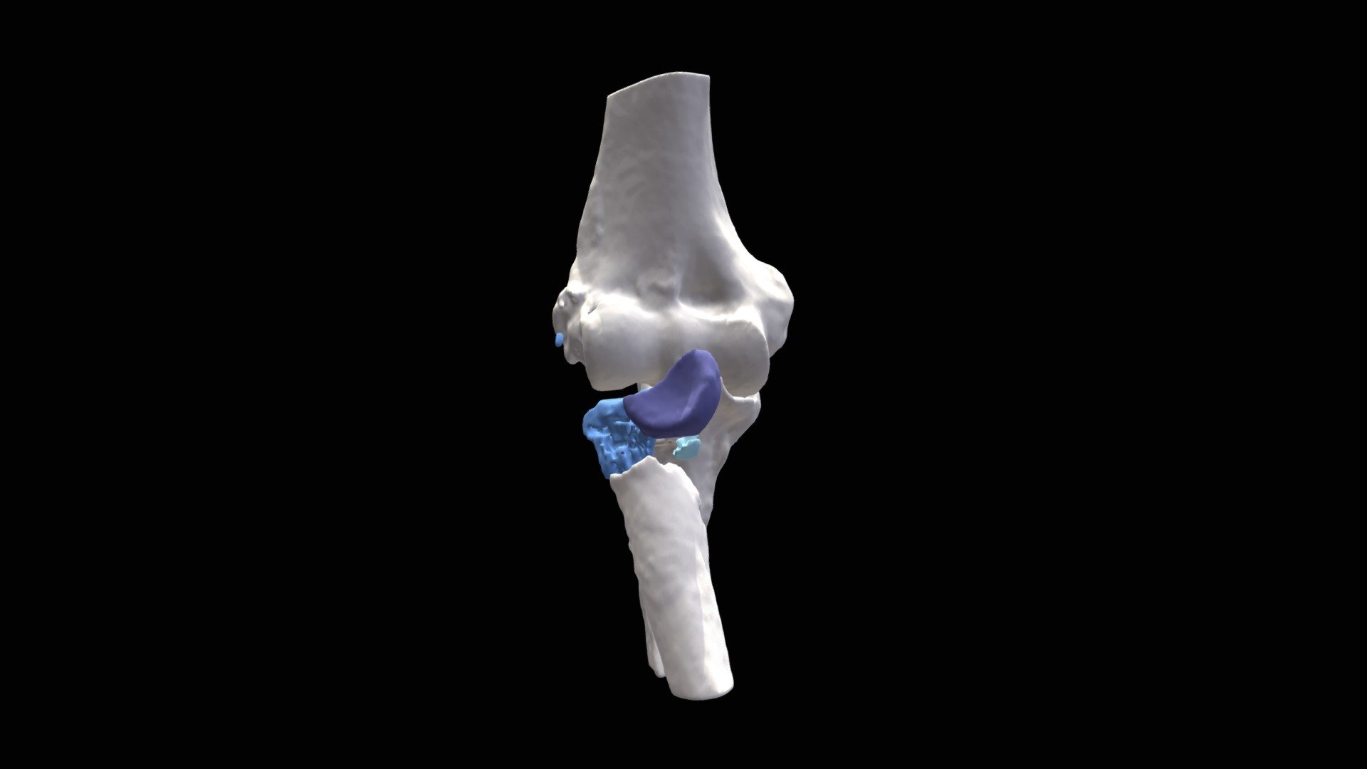 Session 3.3 | Elbow dislocation – ExFix vs Brace - Download Free 3D ...