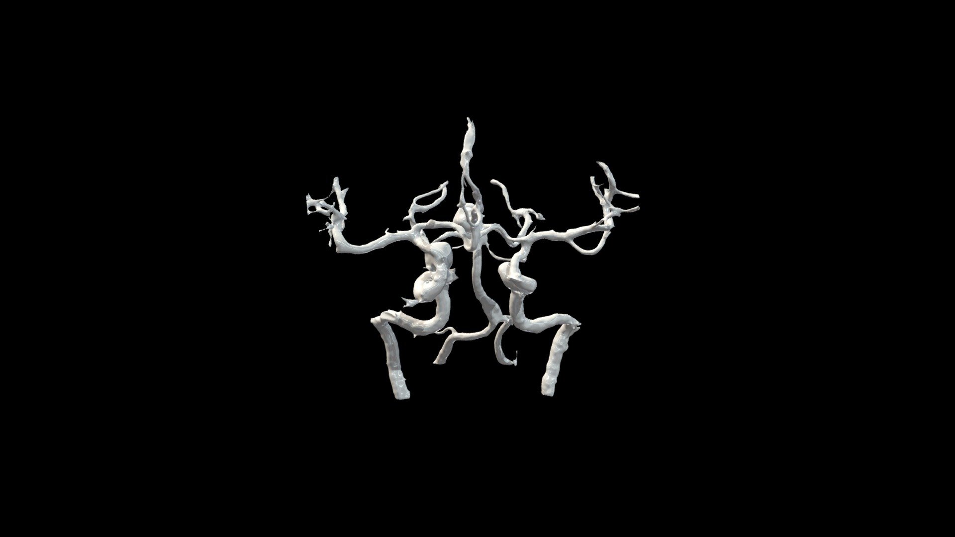 LND - Big Carotid and Basilar Aneurysms - 3D model by Dr. Samuel Damin ...