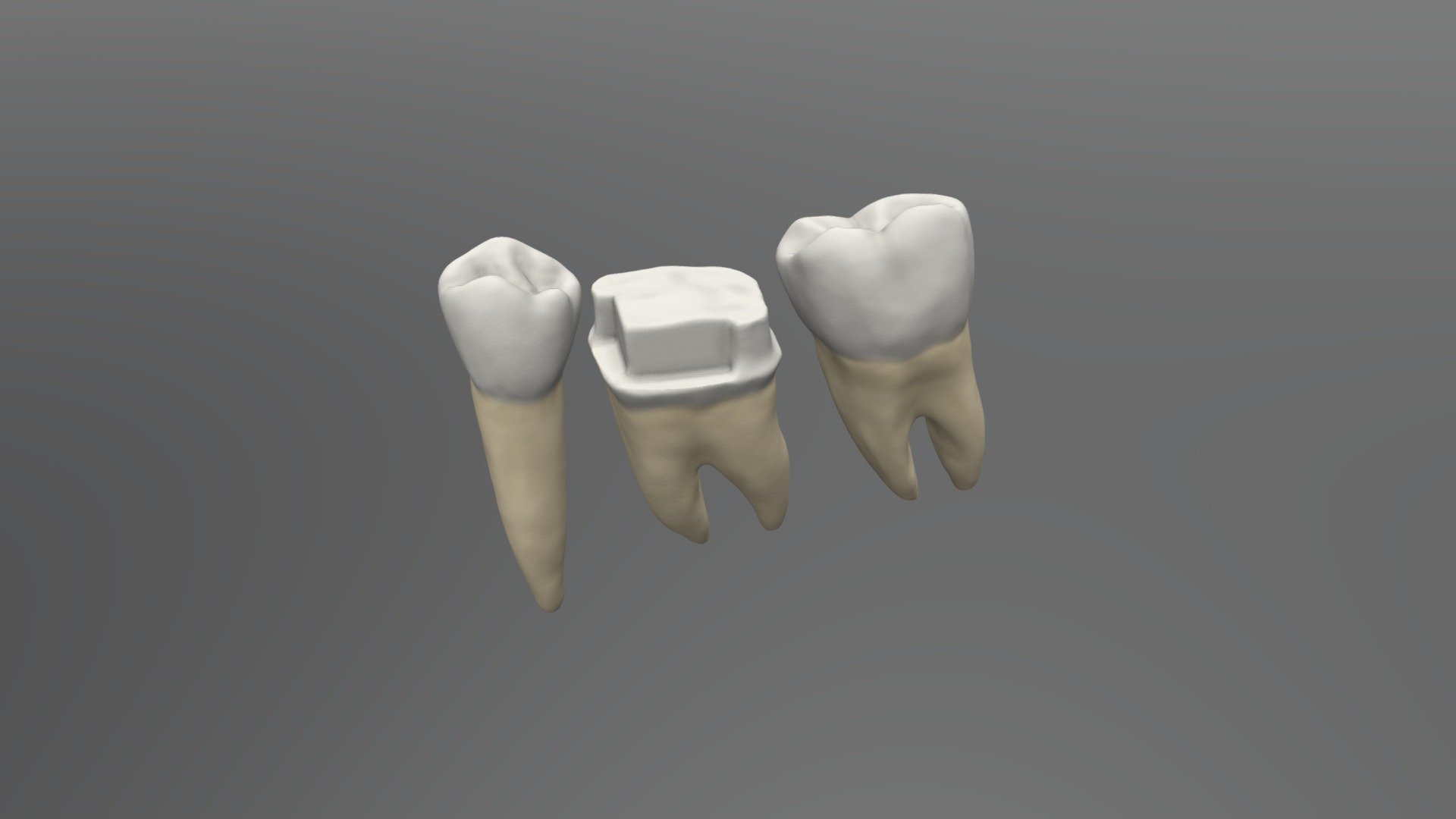 Modified Onlay - 3D model by SDEO [17f8ef5] - Sketchfab
