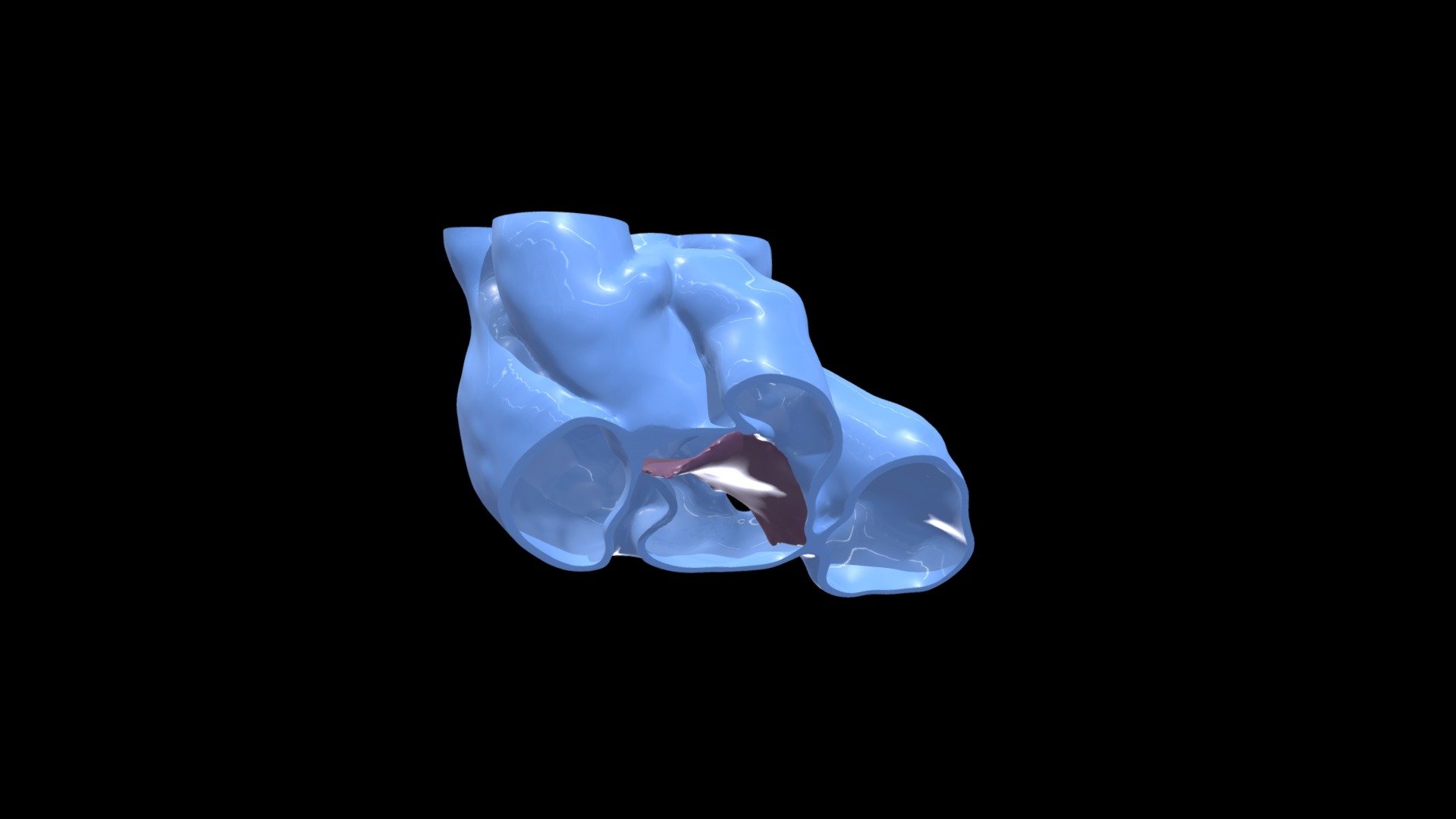 Case 64 Coronal cut with VSD Patch - 3D model by kmaghrabi [1832dc8 ...