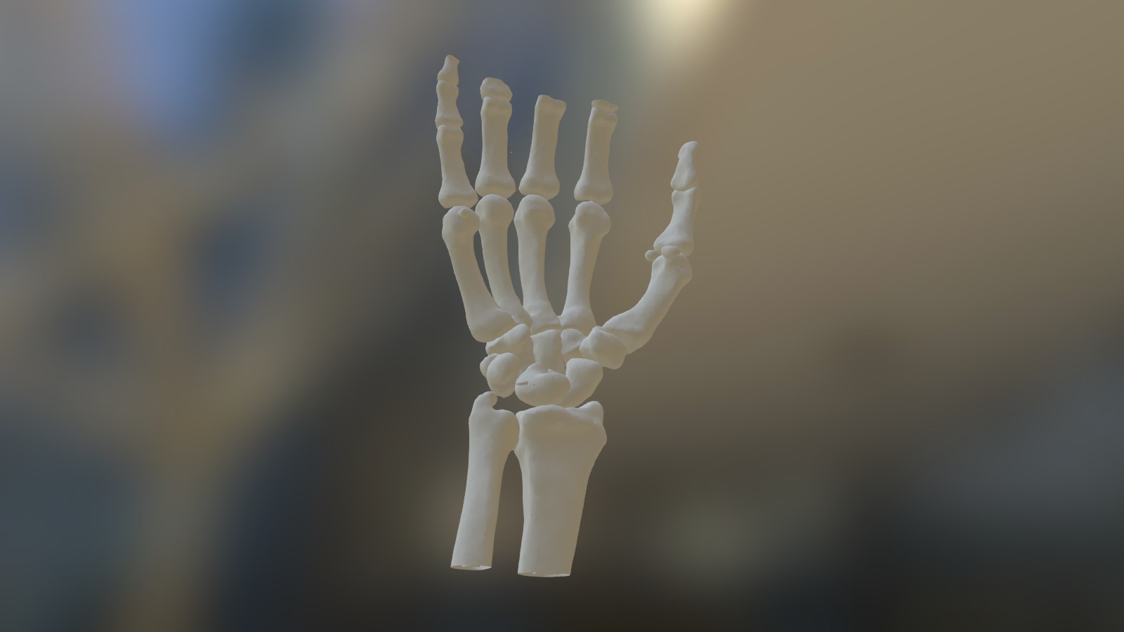 Wrist Fracture - sku251 - 3D model by orto3d [18346cc] - Sketchfab