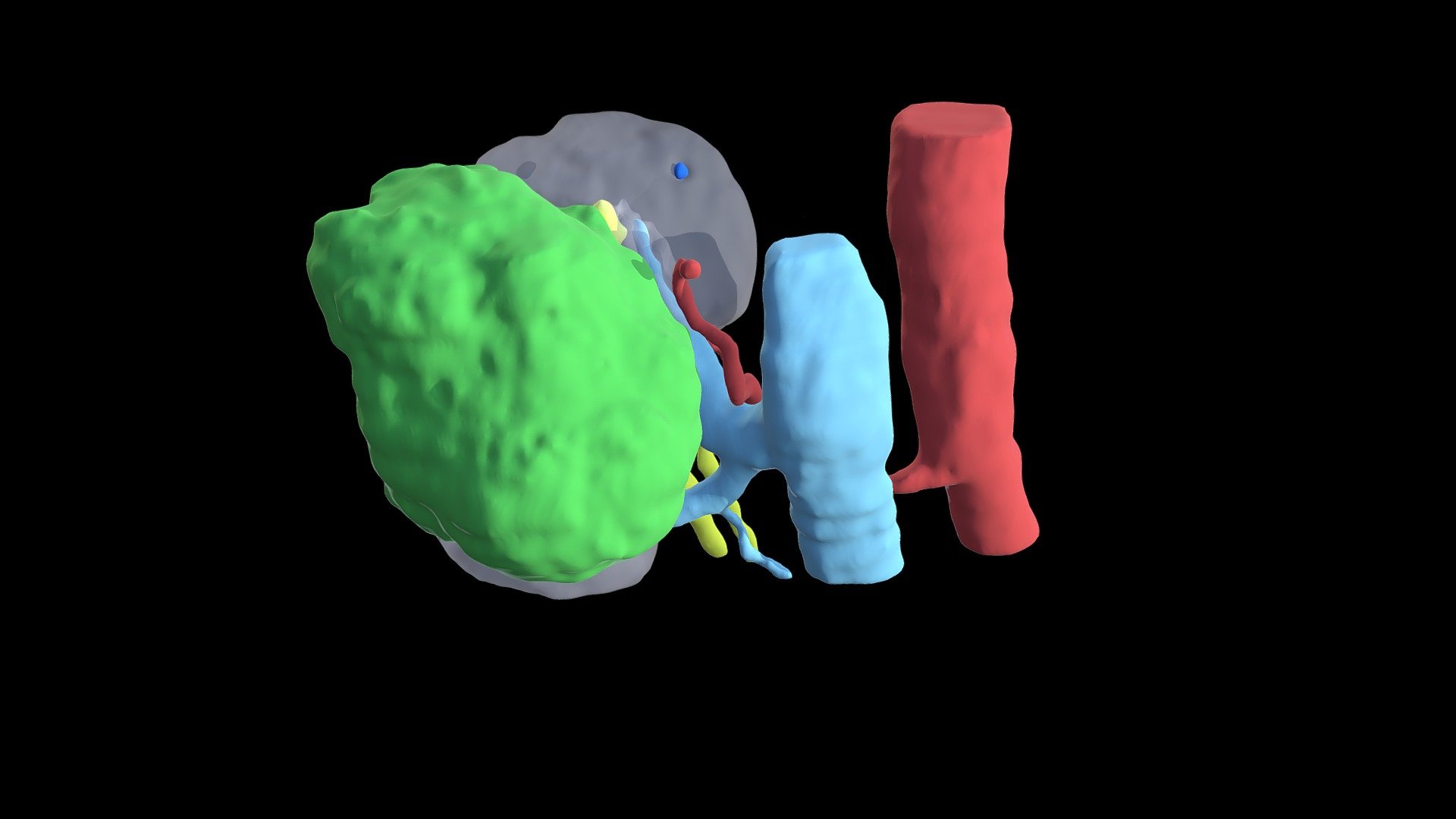 Right Renal Tumor 3D Model By Cirurgic3D neorenal 18969fe