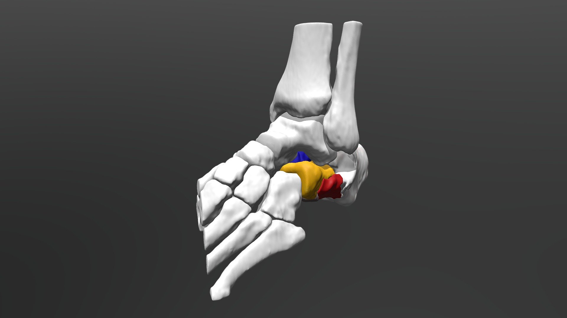 Calcaneus Fracture, 636 - 3D model by valchanov [18d7720] - Sketchfab