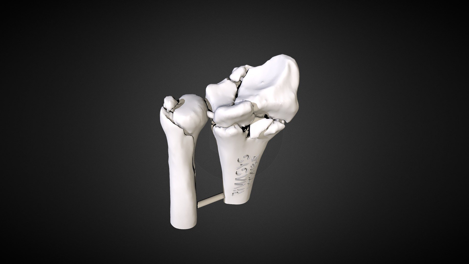 DKOU18 | distal Radius fracture | I-170418-R - 3D model by World ...