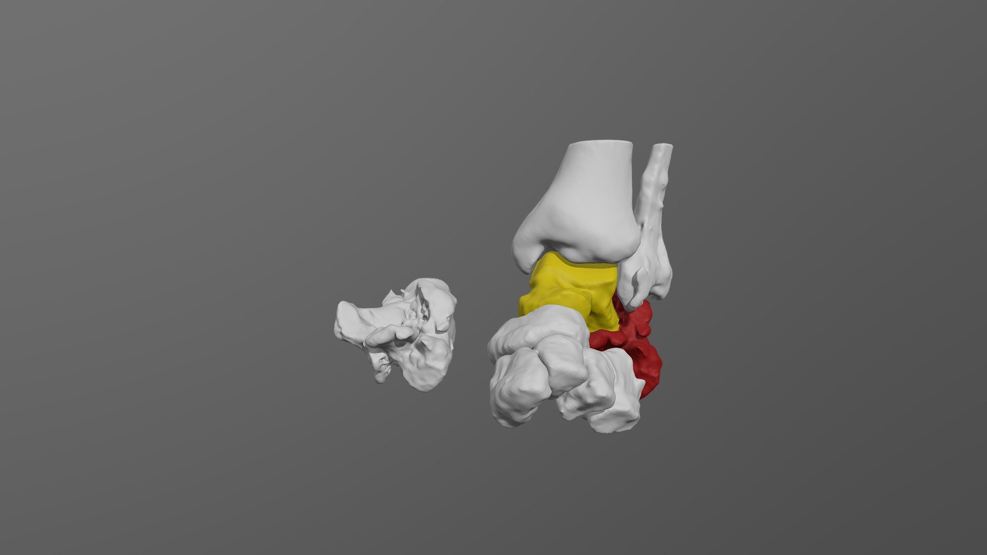Malunited calcaneus post fracture of the ankle - 3D model by valchanov ...