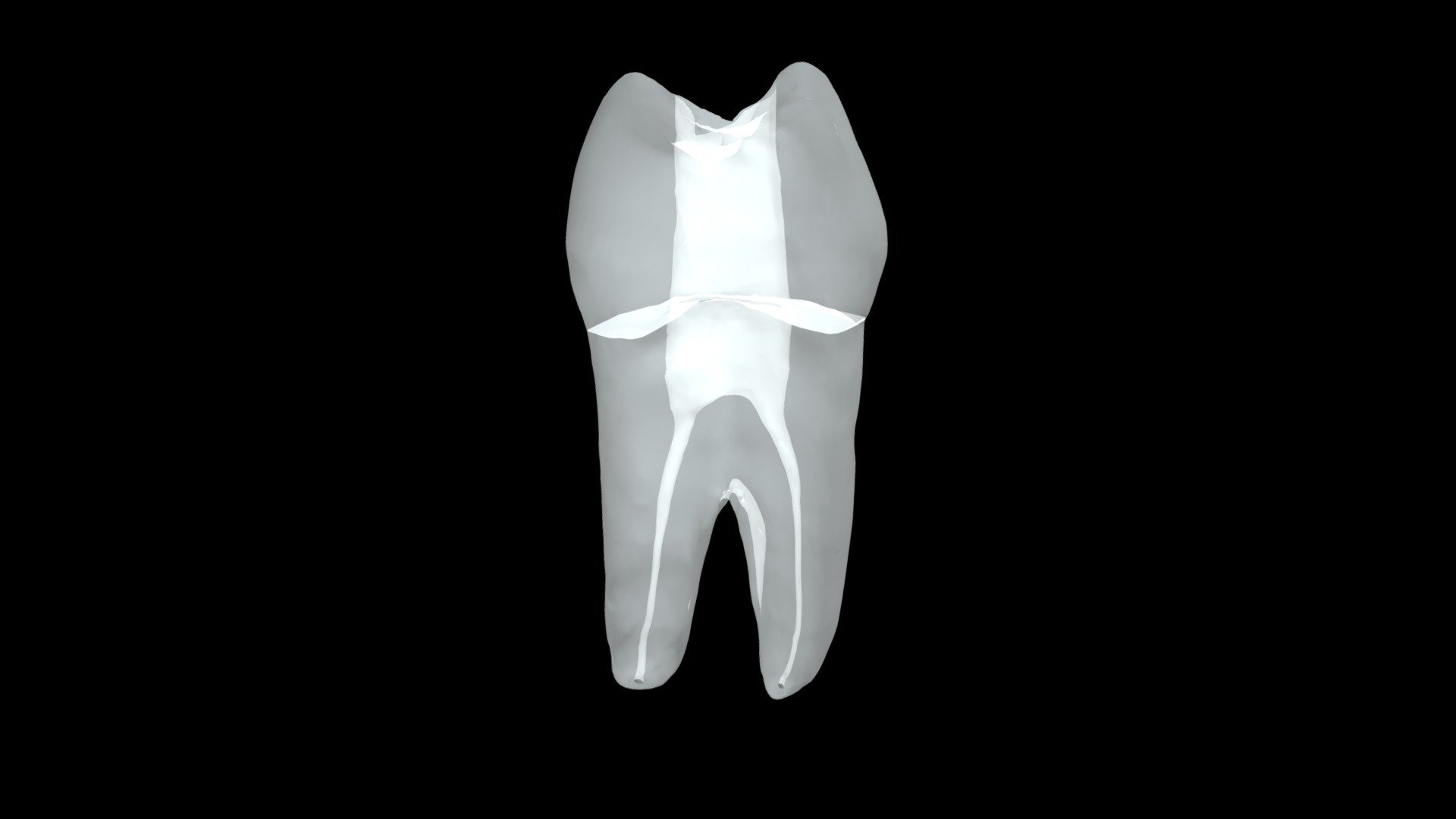 Tooth 5A Pre-Accessed - 3D model by biomed3d [1a1a9b1] - Sketchfab