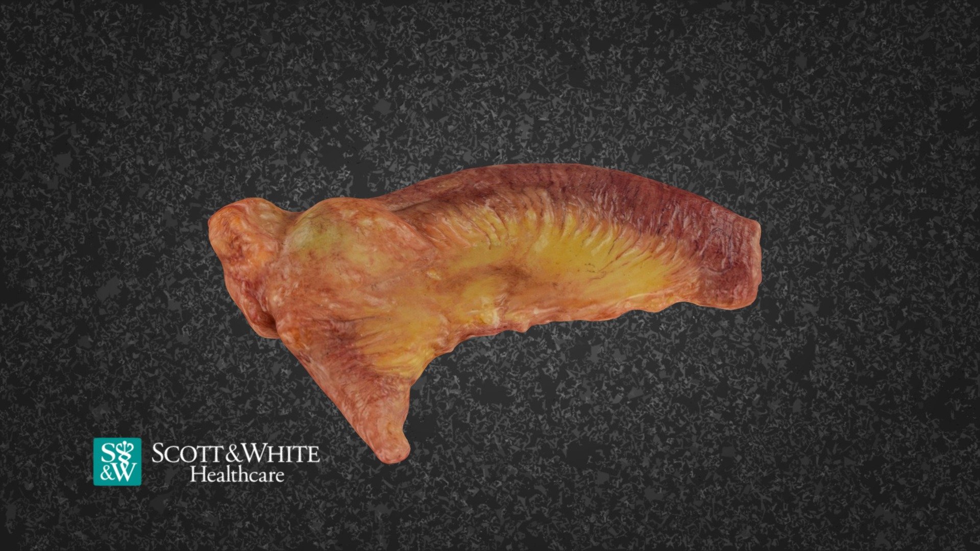 Lymphosarcoma Small Bowel & Ileum 159078 - 3D model by Scott & White ...