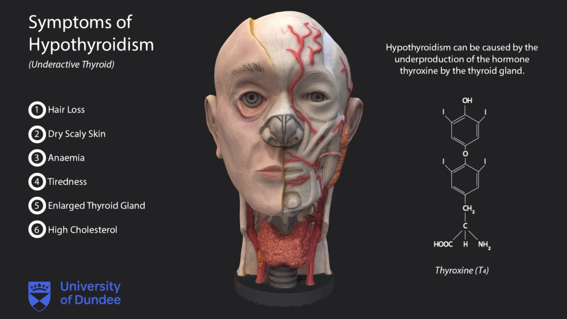 Under Active Thyroid (Hypothyroidism) - 3D model by University of ...