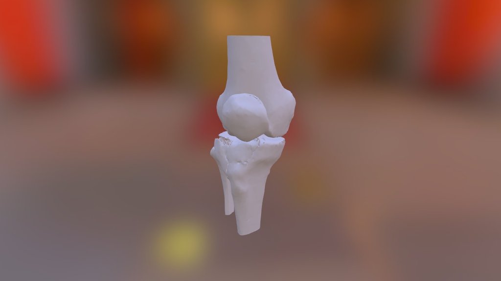 Knee - Proximal Tibia Fracture sku 029 - 3D model by orto3d [1b31d9e ...