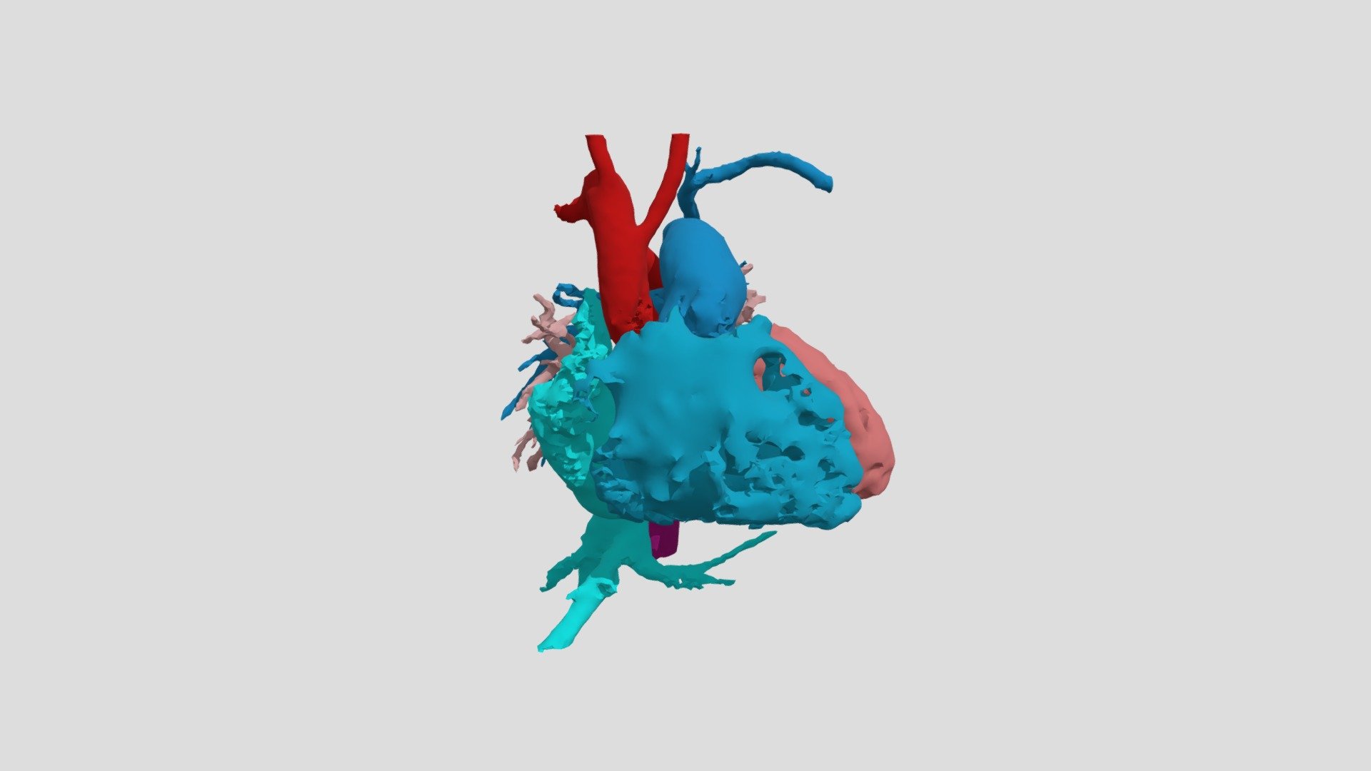 Coarctation of Aorta (S0282) - 3D model by NCHS Cardiac Advanced ...