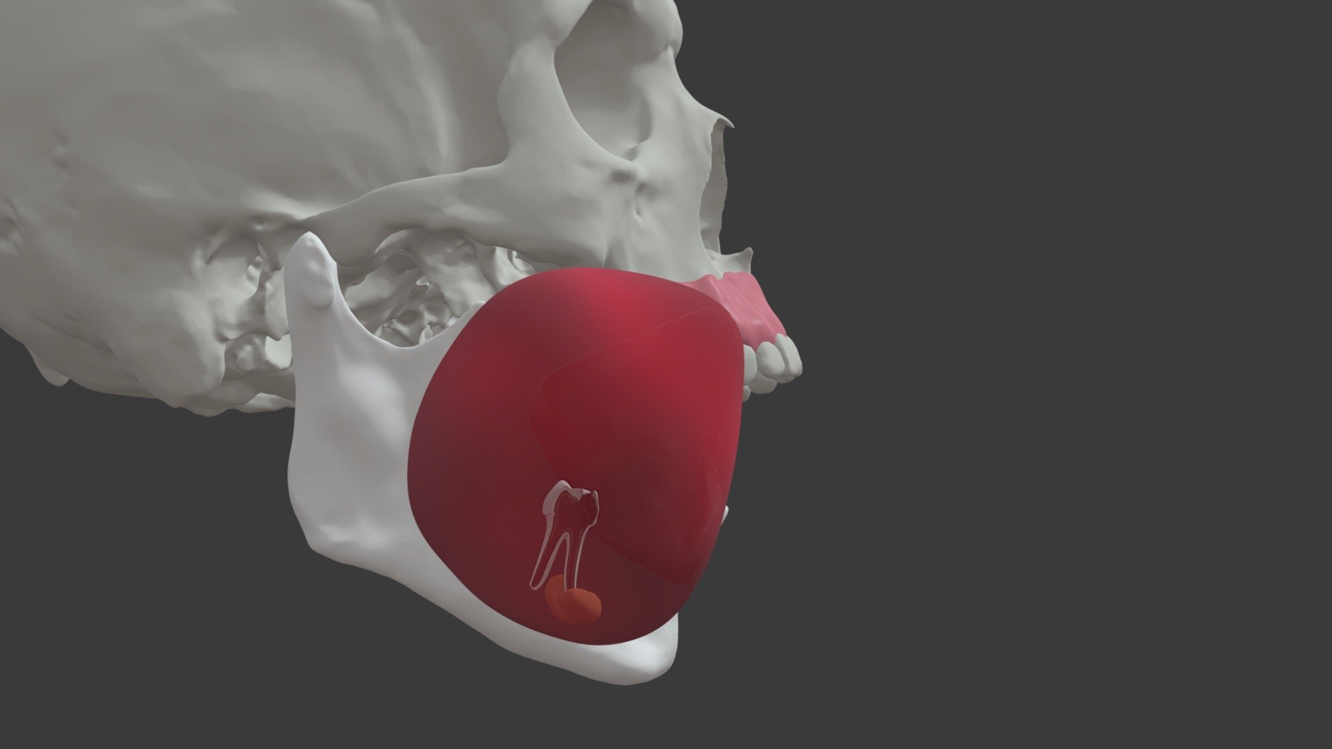 Stage 5 Mandibular Molar Infection Pathway 2 - 3D model by University ...