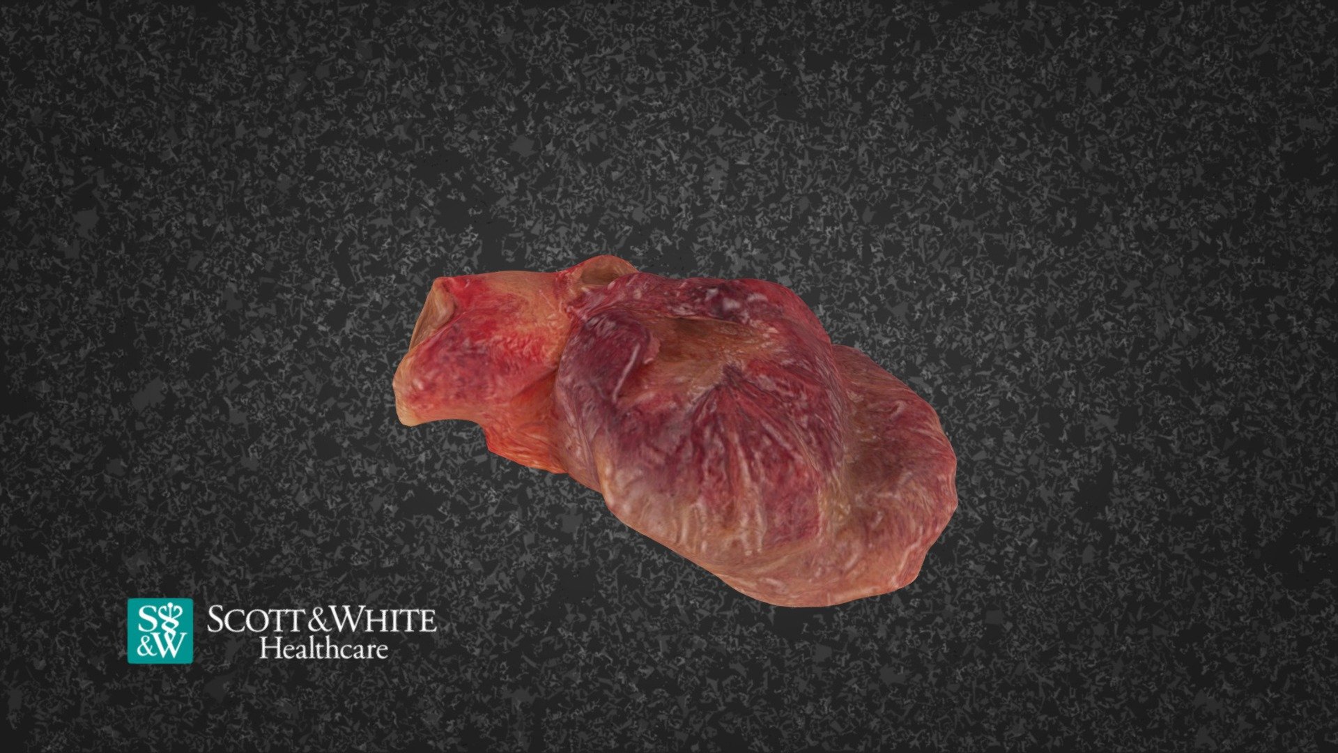 Chronic Ulcer Of The Jejunum 75442 - 3D model by Scott & White Moulage ...