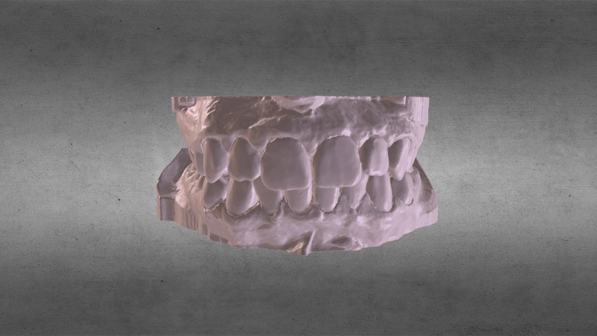 DR Molnar1 ORTHO occlusion - 3D model by attila_hu [1ebe00f] - Sketchfab