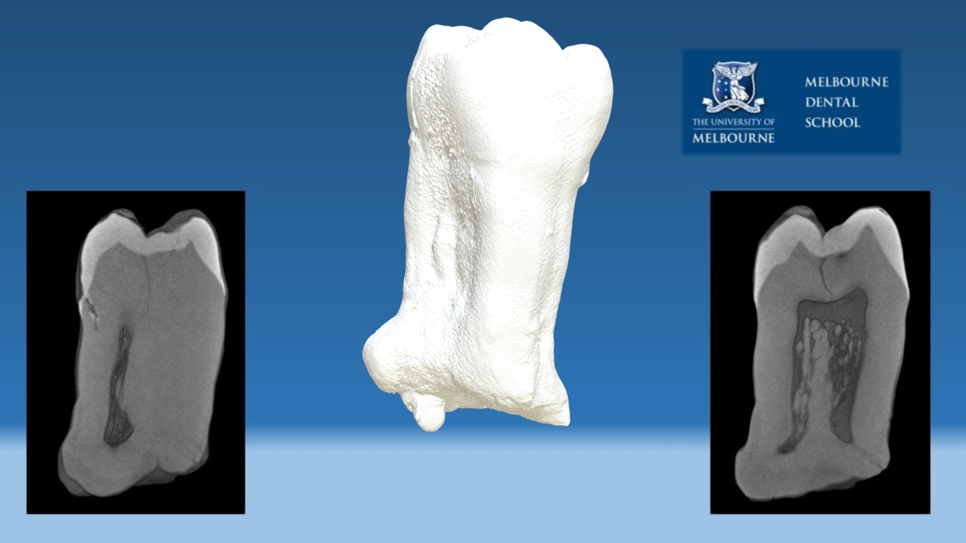 taurodont molar - 3D model by Melbourne Dental School (@Ritasodontology ...