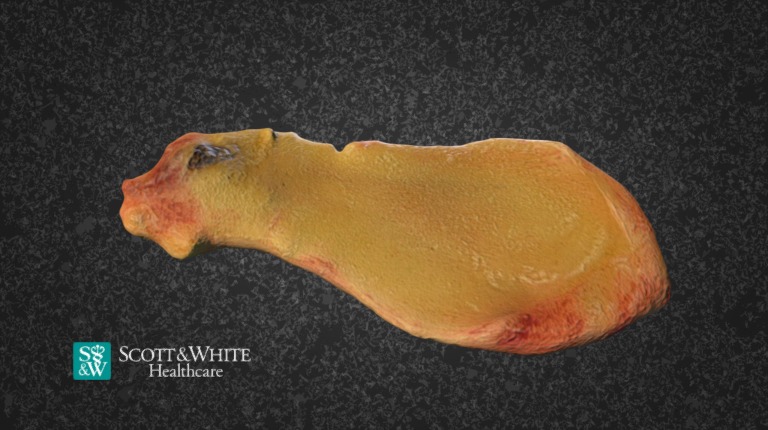 Gallbladder Carbon Gallstone 98211 - 3D model by Scott & White Moulage ...