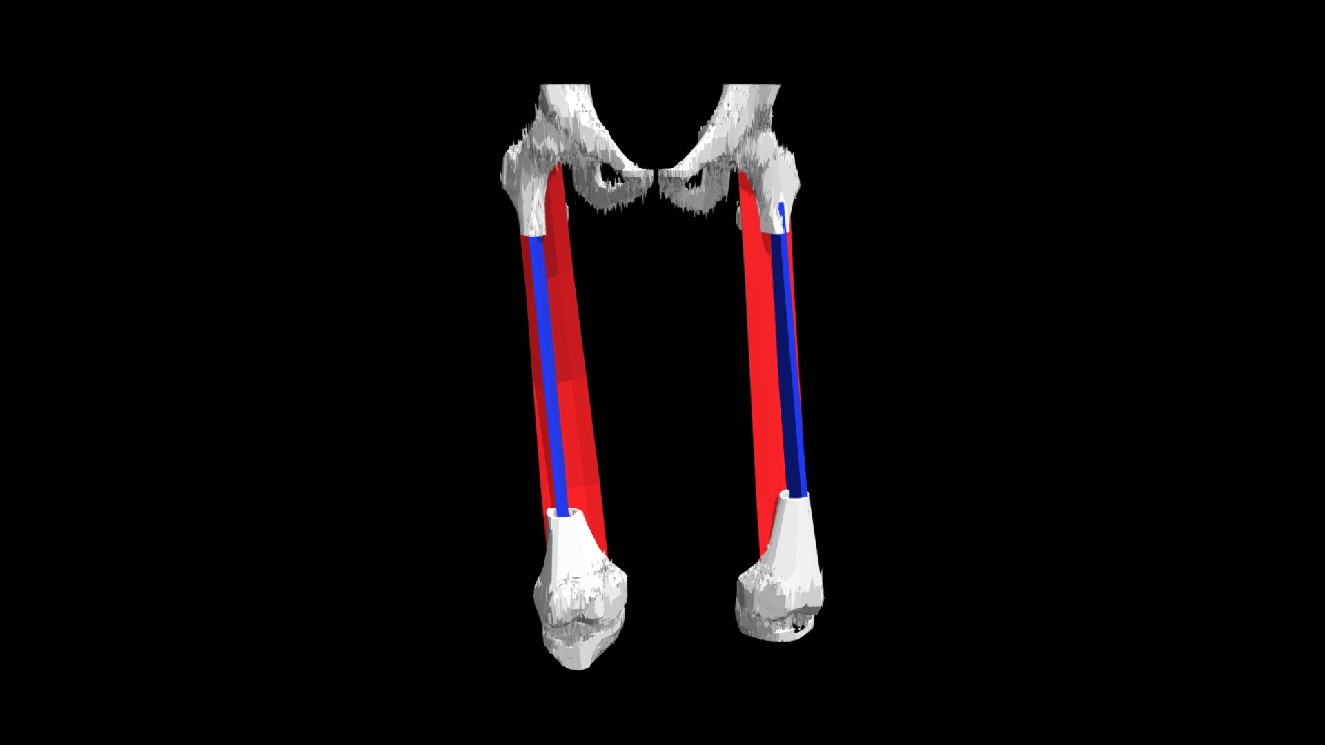 Femoral Anteversion - 3D model by Lincoln Wong (@lincolnwong) [1f7fc5d ...