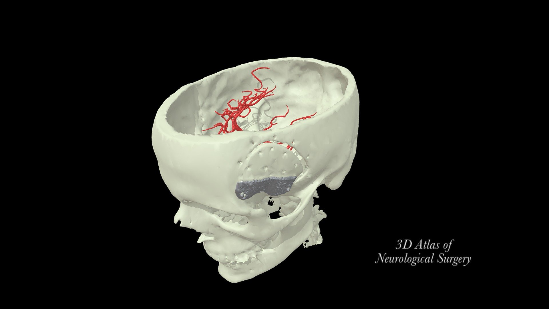 Left pterional approach reconstruction - 3D model by 3D Atlas of ...