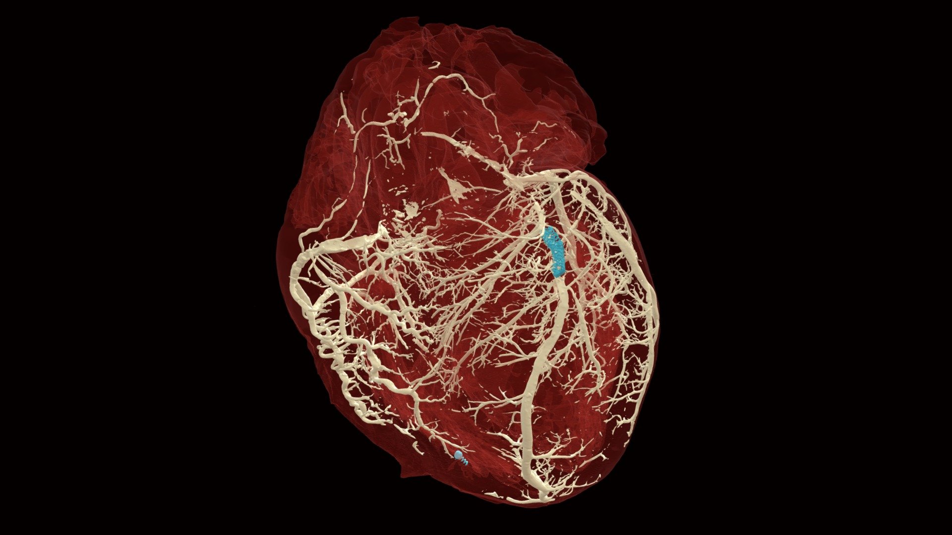 Heart0251: Coronaries, Stent, Pacemaker Lead - Download Free 3D model ...