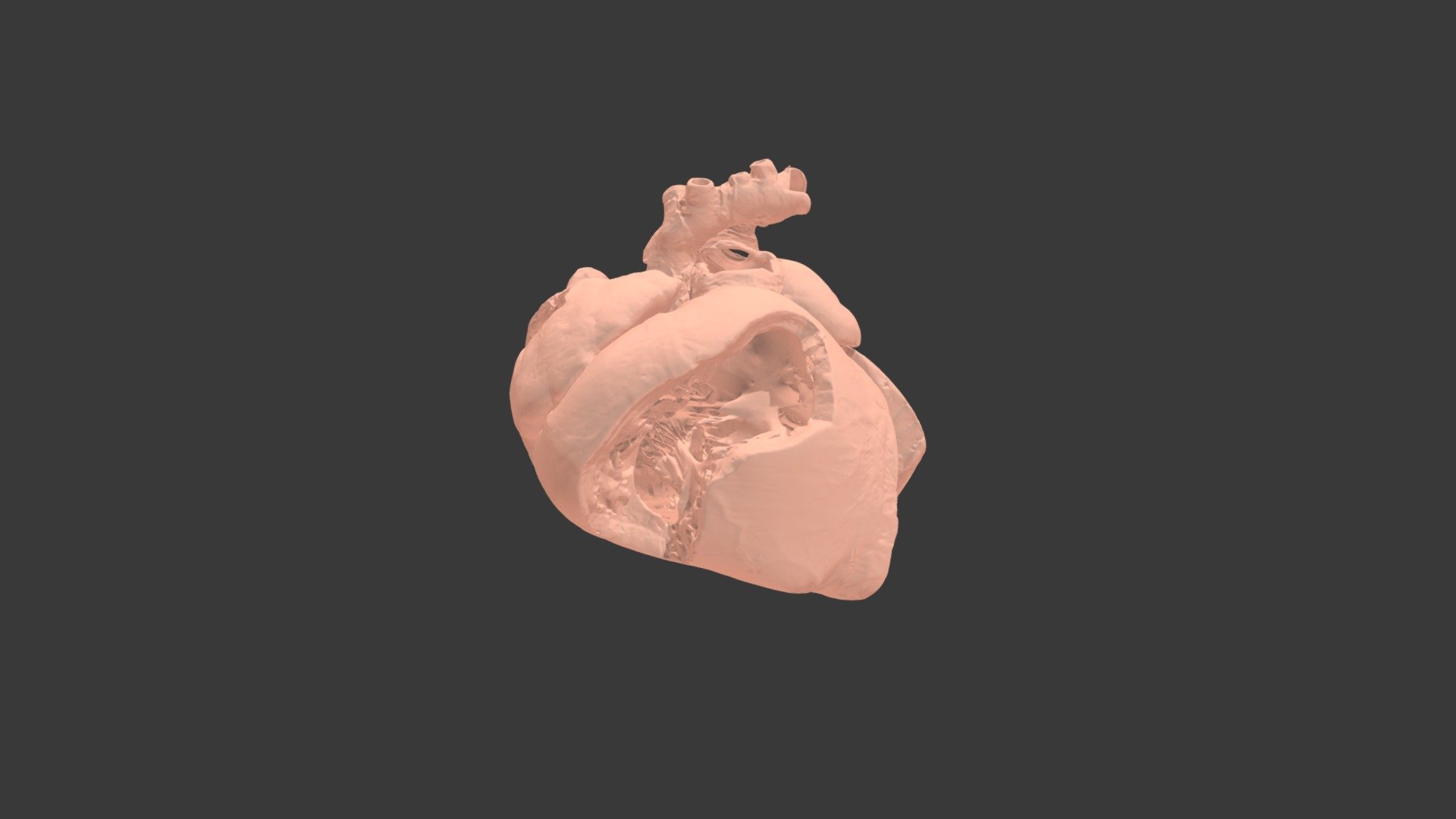 VSD #4 - {S,D,S} with conoventricular VSD - 3D model by heartmodels ...
