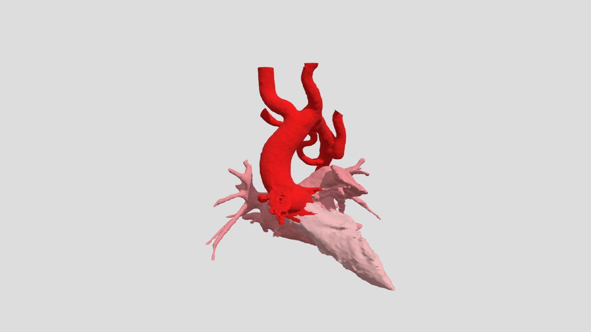 Coarctation of Aorta (S0302) - 3D model by NCHS Cardiac Advanced ...