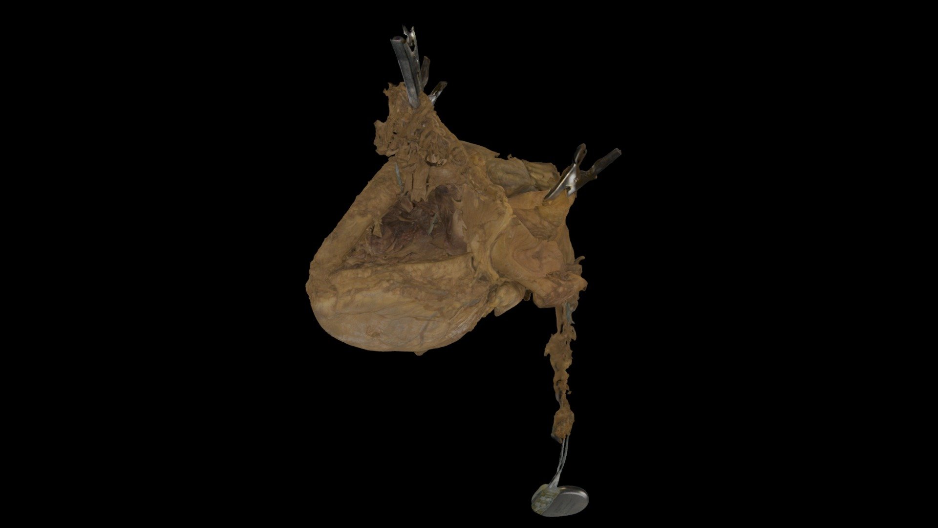 Dissected Human Heart with Pacemaker - Download Free 3D model by ...