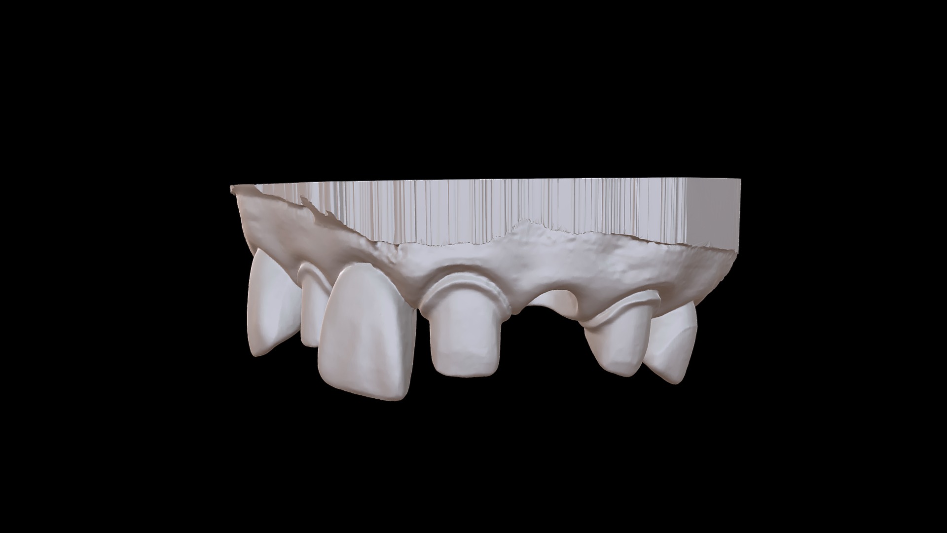 #7 Single Unit , 9-11 FPD Prep - 3D model by bchui [22a77de] - Sketchfab