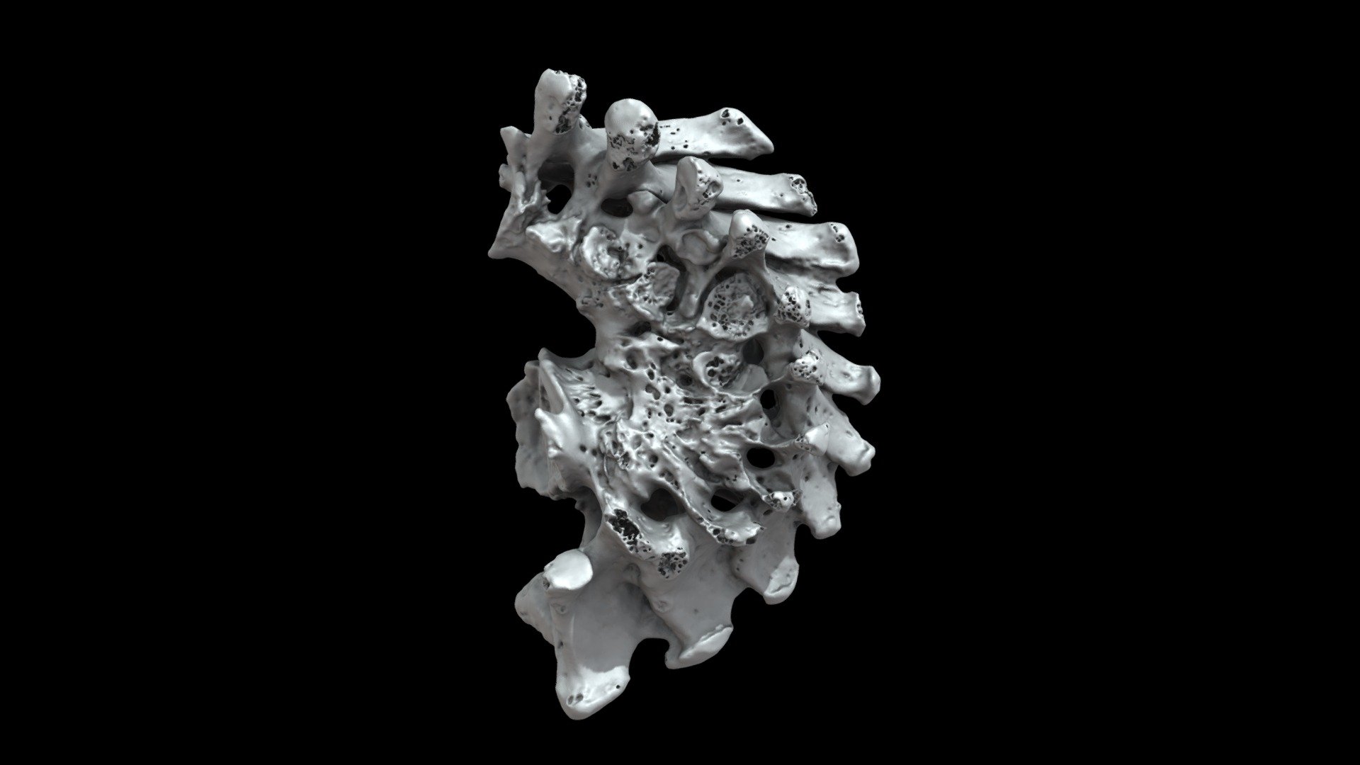 Vertebrae with Tuberculosis (VCU_3D_5362) - 3D model by Virtual ...