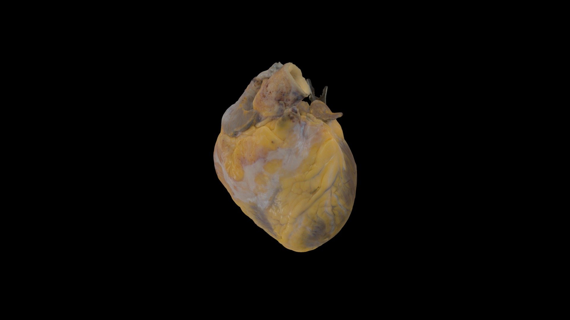 Fixed Human Heart Donation - Download Free 3D model by VisibleHeartLabs ...