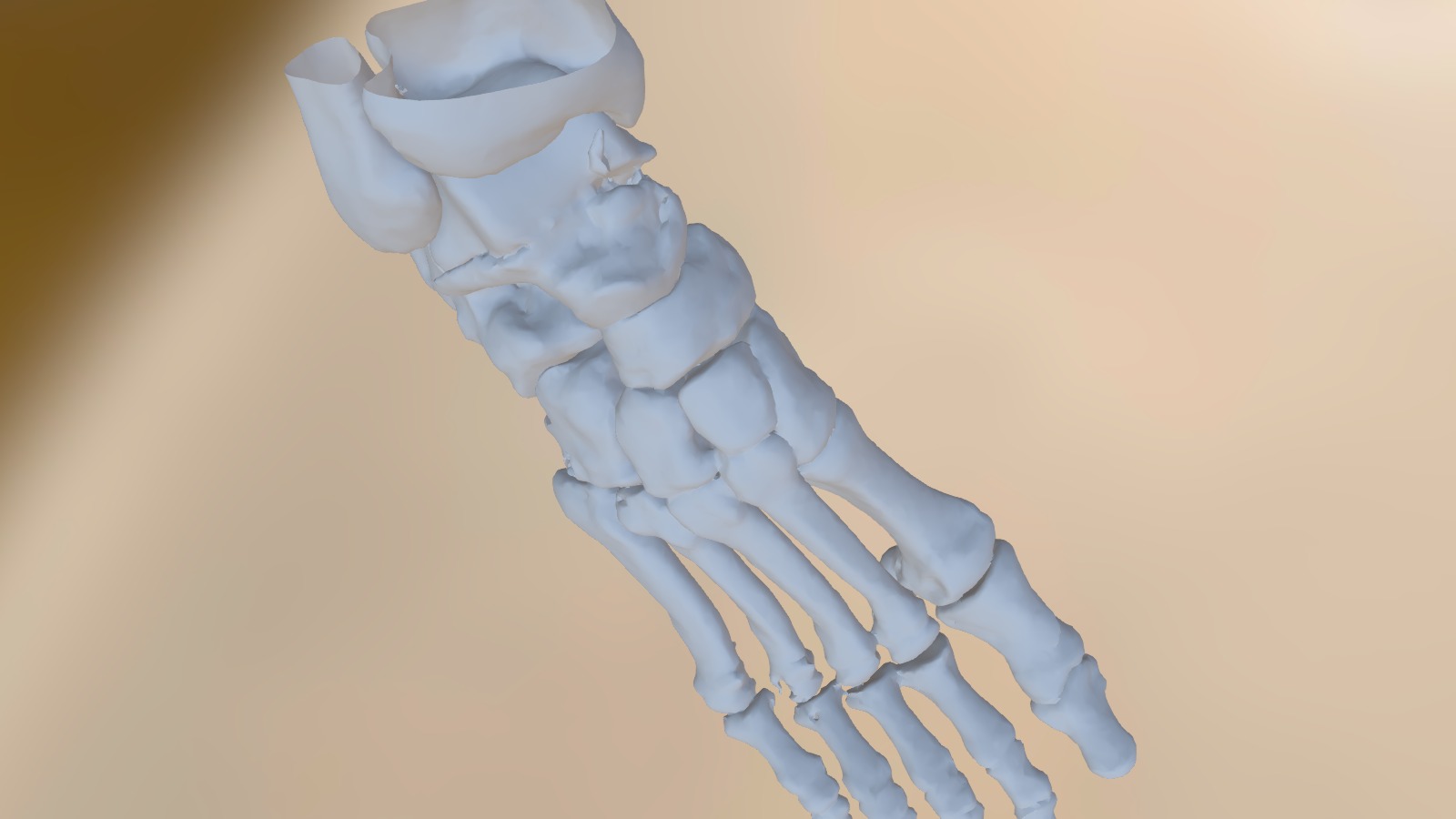 Foot and Ankle - Talus fracture - sku 164 - 3D model by orto3d [23ad273 ...
