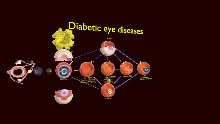 Diabetic 3D models - Sketchfab