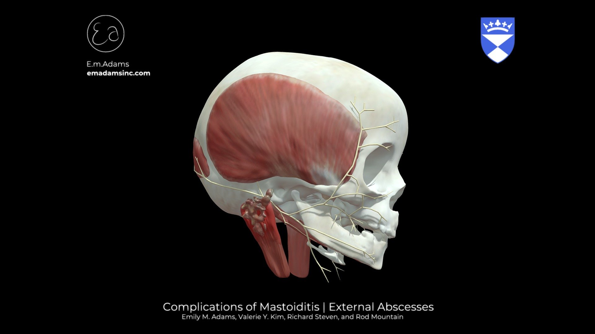 Bezold Abscess - 3D model by University of Dundee, CAHID (@anatomy ...