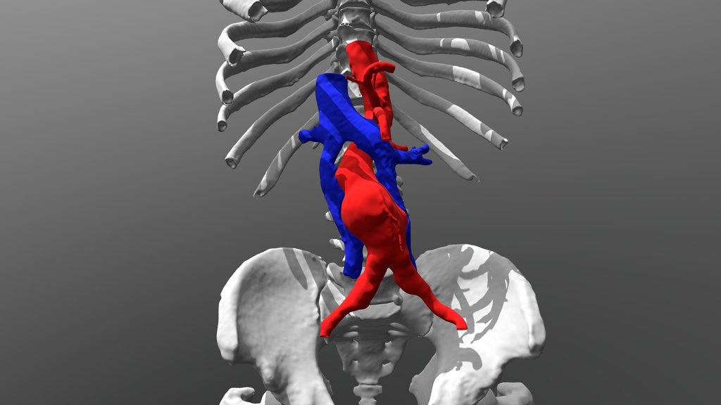 Pathology - A 3D model collection by Chair_Digital_Anatomy - Sketchfab