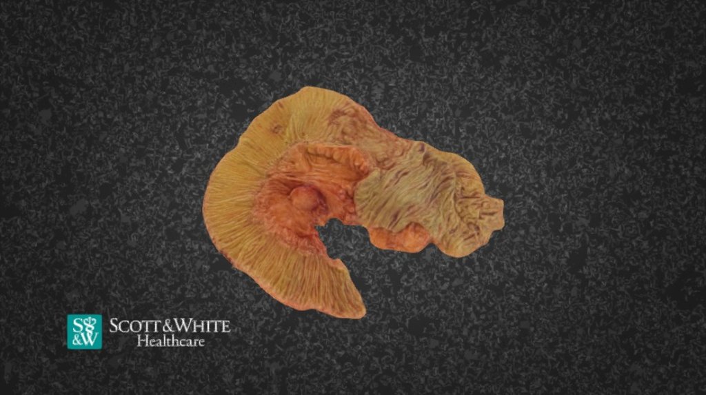 Ileum- Regional Ileitis 319504 - 3D model by Scott & White Moulage ...
