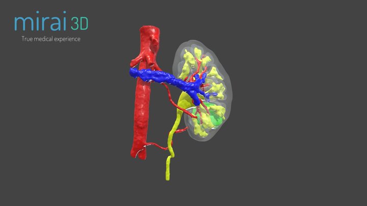 Nephrectomy 3D models - Sketchfab