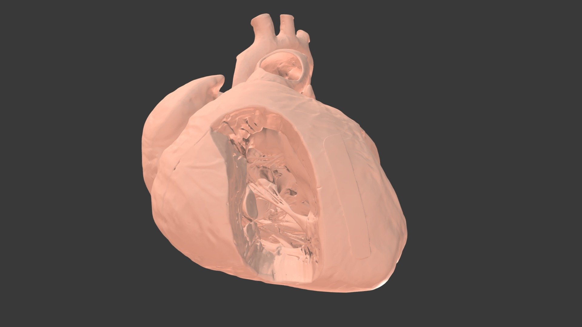 CAVC #1 - {S,D,S} with Complete CAVC (Type A) - 3D model by heartmodels ...