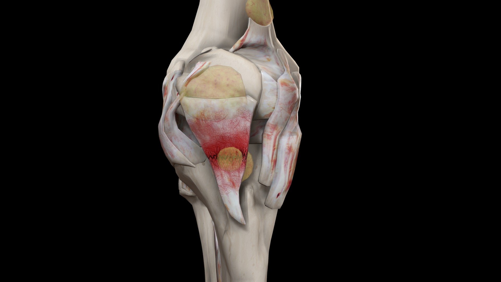 Patella Tendon Rupture - 3D model by Connections XR (@connectionsxr ...