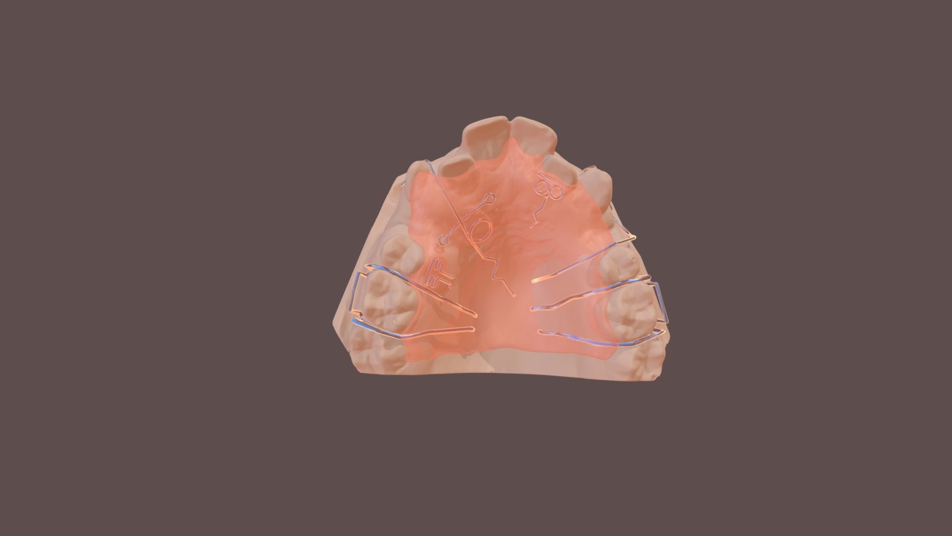 Orthodontic Removable Appliance - 3D model by Eric Ho (@justericho ...