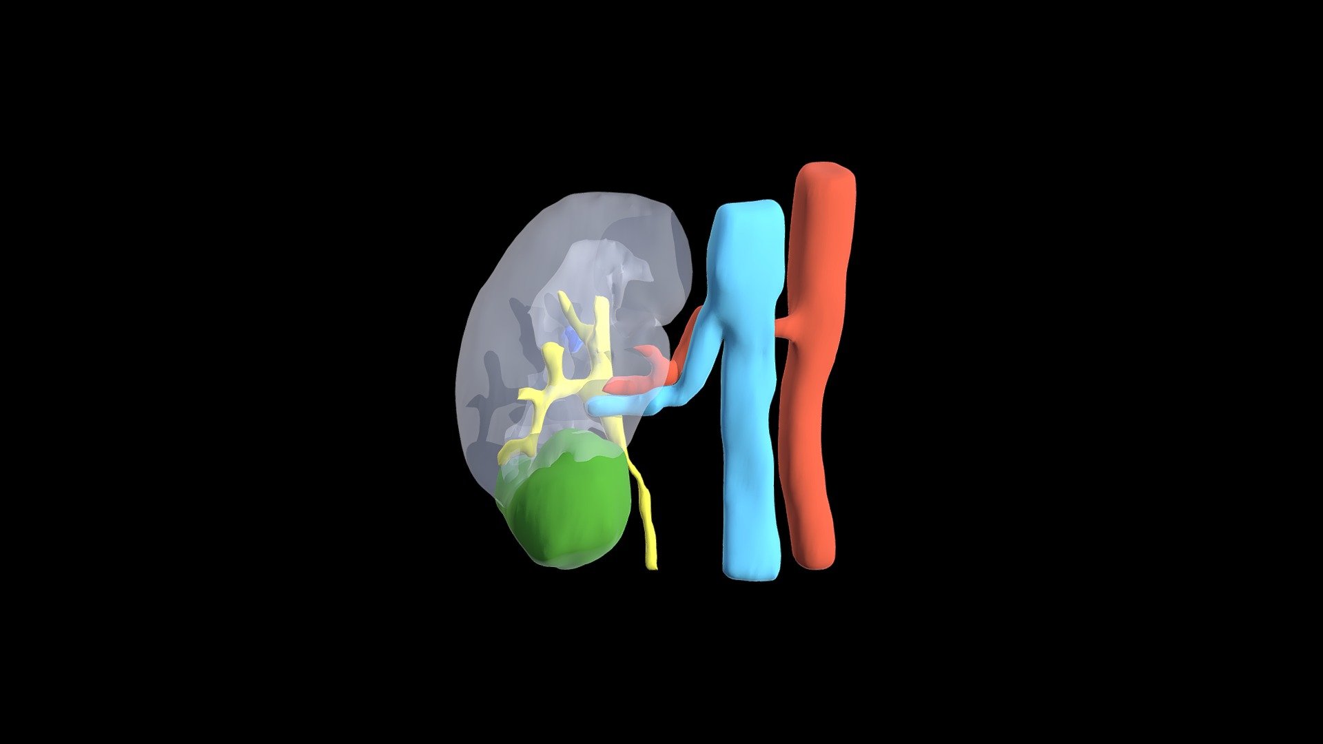 Right Renal Tumor (M.S.S.M.) - 3D model by Cirurgic3D (@neorenal ...